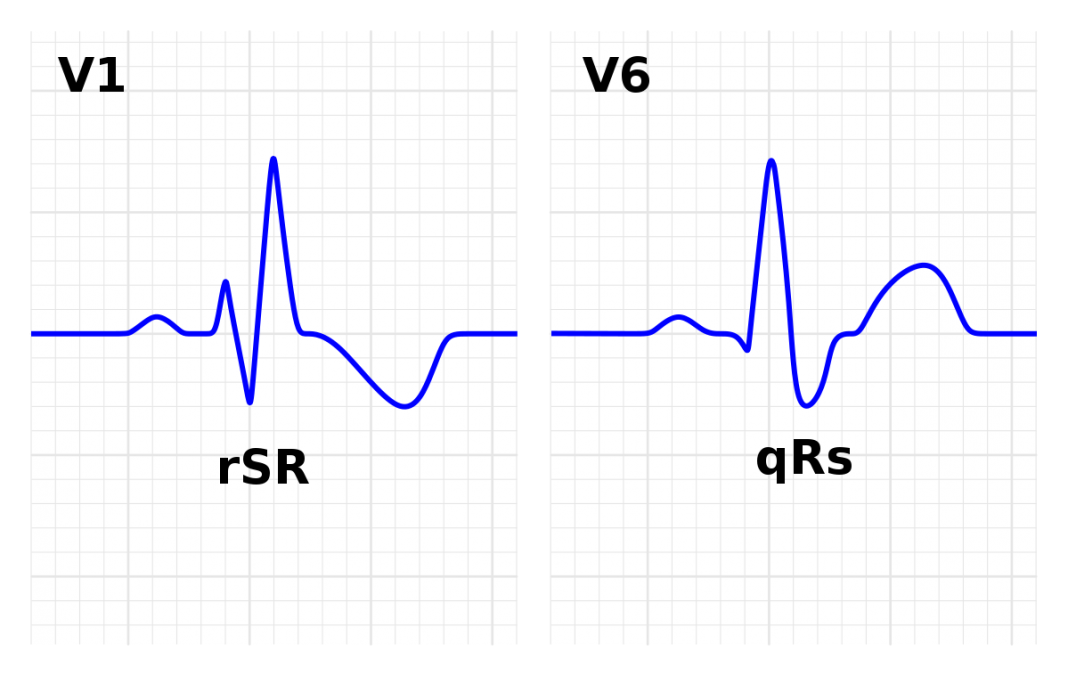 Incomplete Right Bundle Branch Block Symptoms And Causes